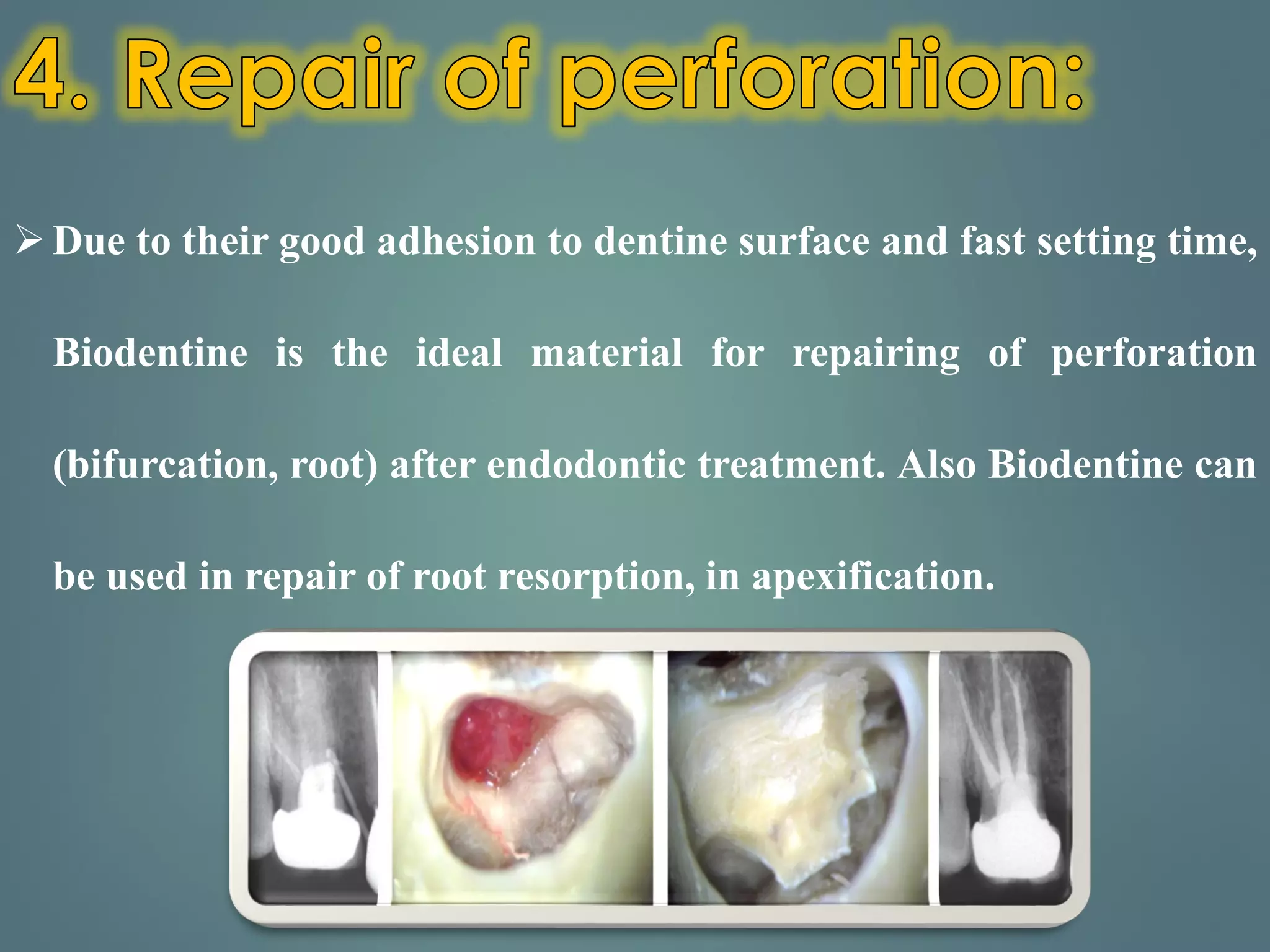 Biodentine™ | PDF