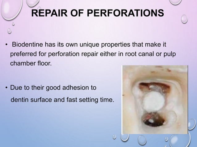 Biodentine (newer material in dentistry) | PPTX | Oral care | Personal Care
