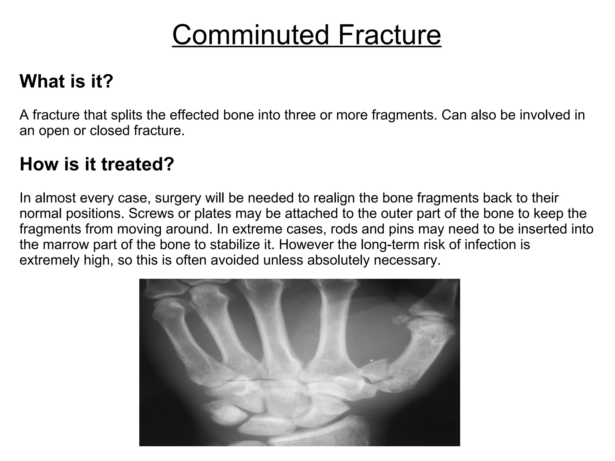 Chapter 4 Fractures | PPT