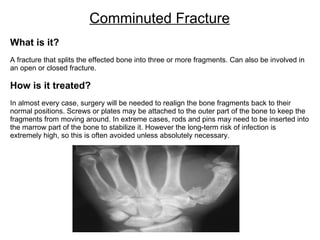 Chapter 4 Fractures | PPT