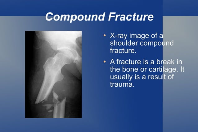 Bio fracture | PPT