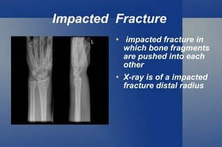Bio fracture | PPT