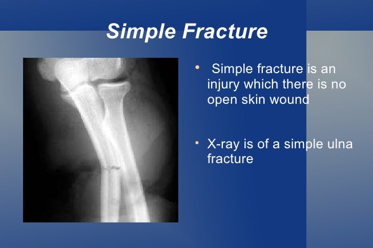 Online streaming A Simple Fracture in english in 2160 - bestrfil