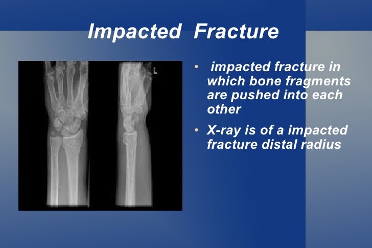 Bio fracture