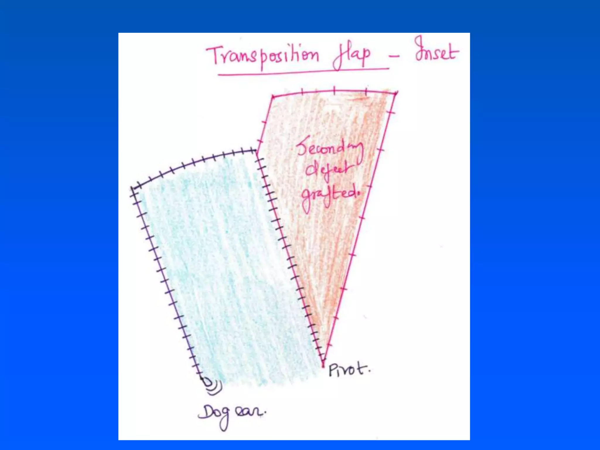 Biogeometry of transposition flap | PPTX