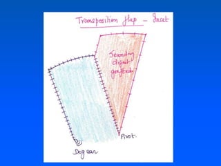 Biogeometry of transposition flap | PPTX