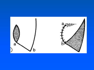 Biogeometry of transposition flap | PPTX