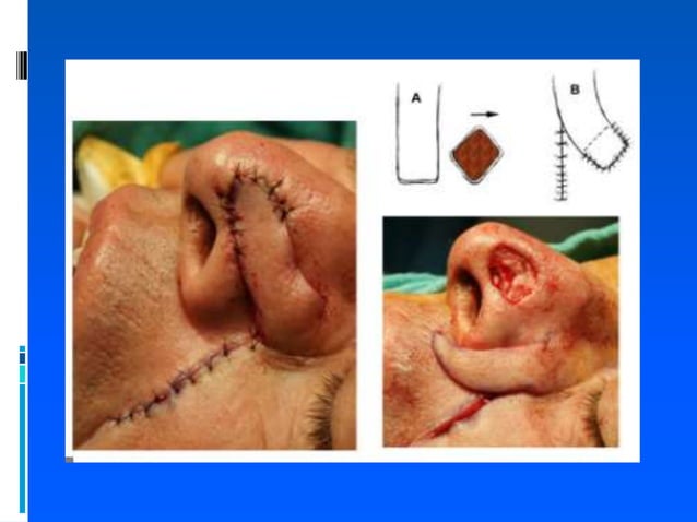 Biogeometry of transposition flap | PPTX