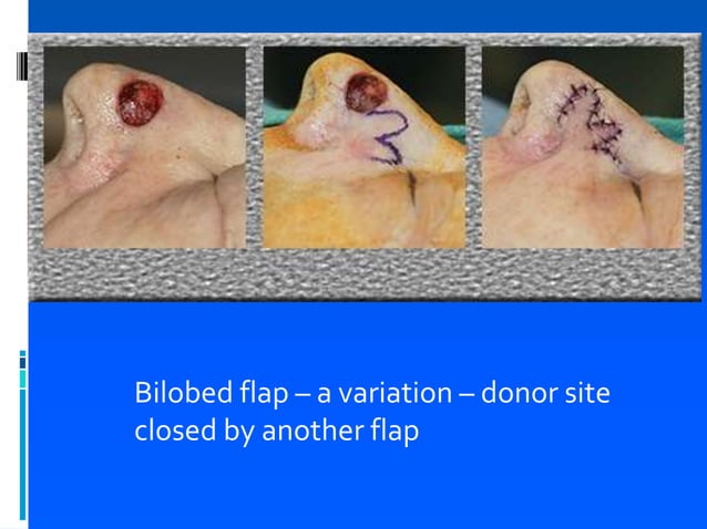 Biogeometry of transposition flap | PPTX