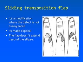 Transposition Flap