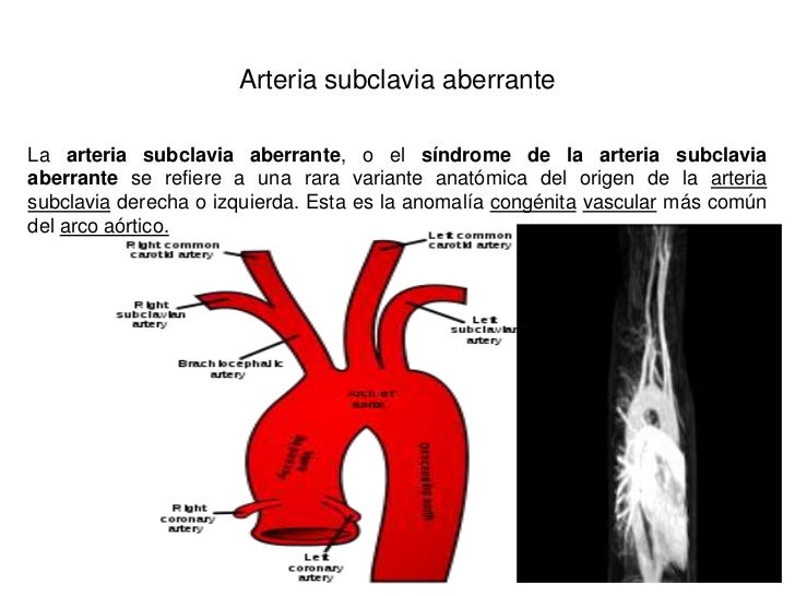 Arteria Lusoria
