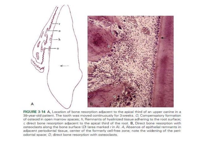 Biological basis of tooth movement | PPTX | Dental Health | Diseases ...