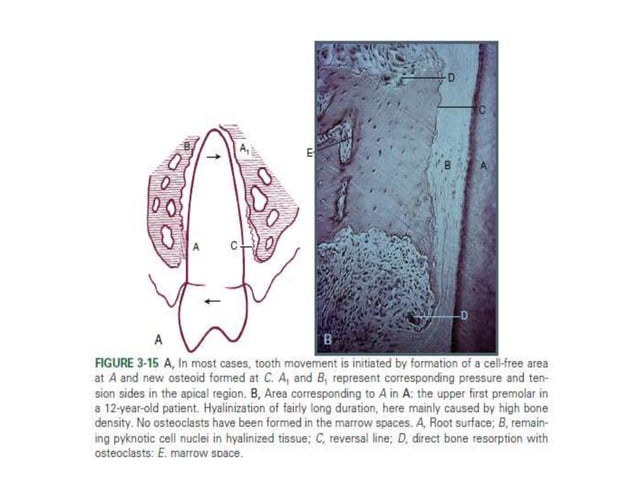 Biological basis of tooth movement | PPTX | Dental Health | Diseases ...