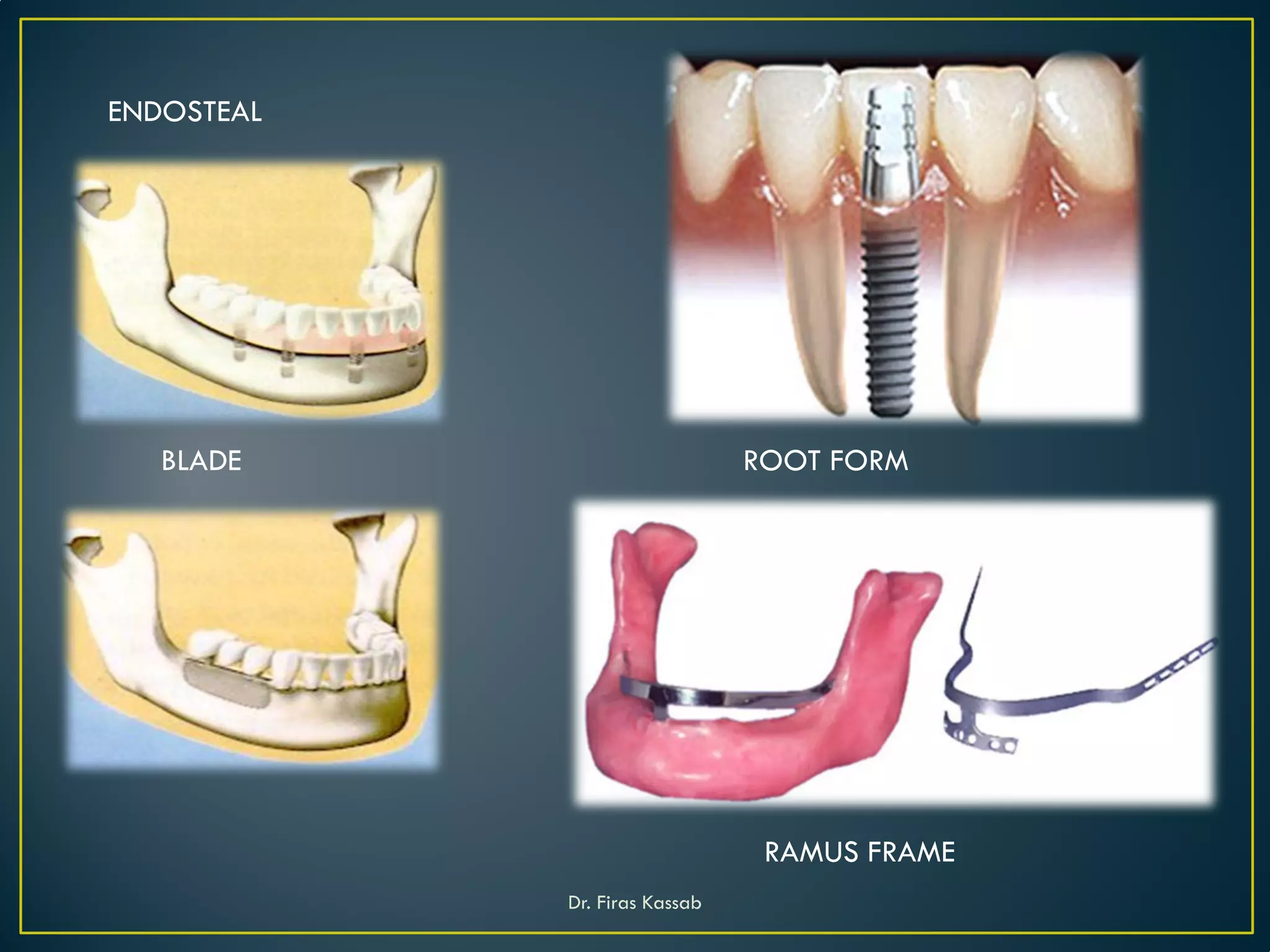 Biological considerations of dental implant | PDF
