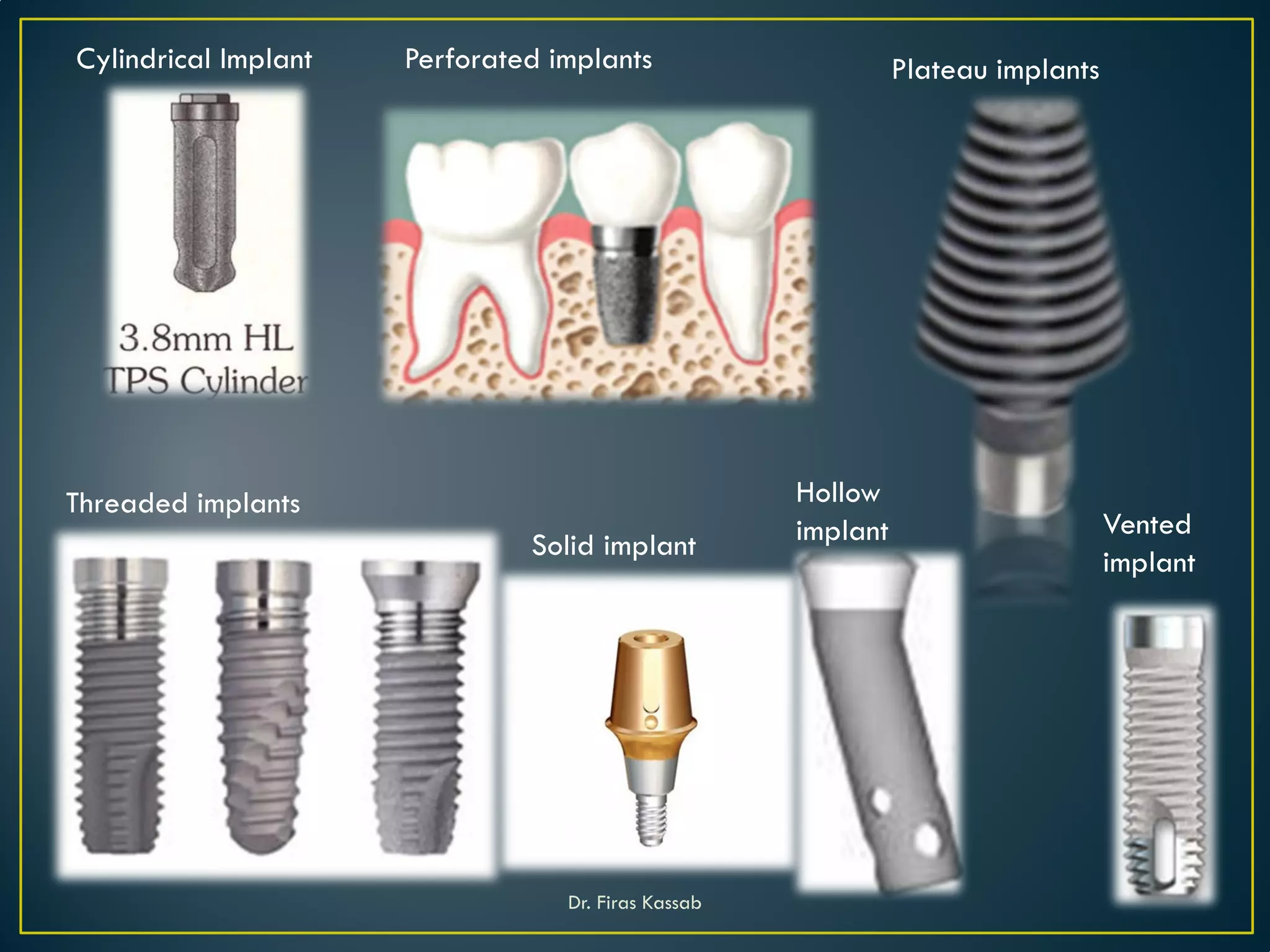 Biological considerations of dental implant | PDF