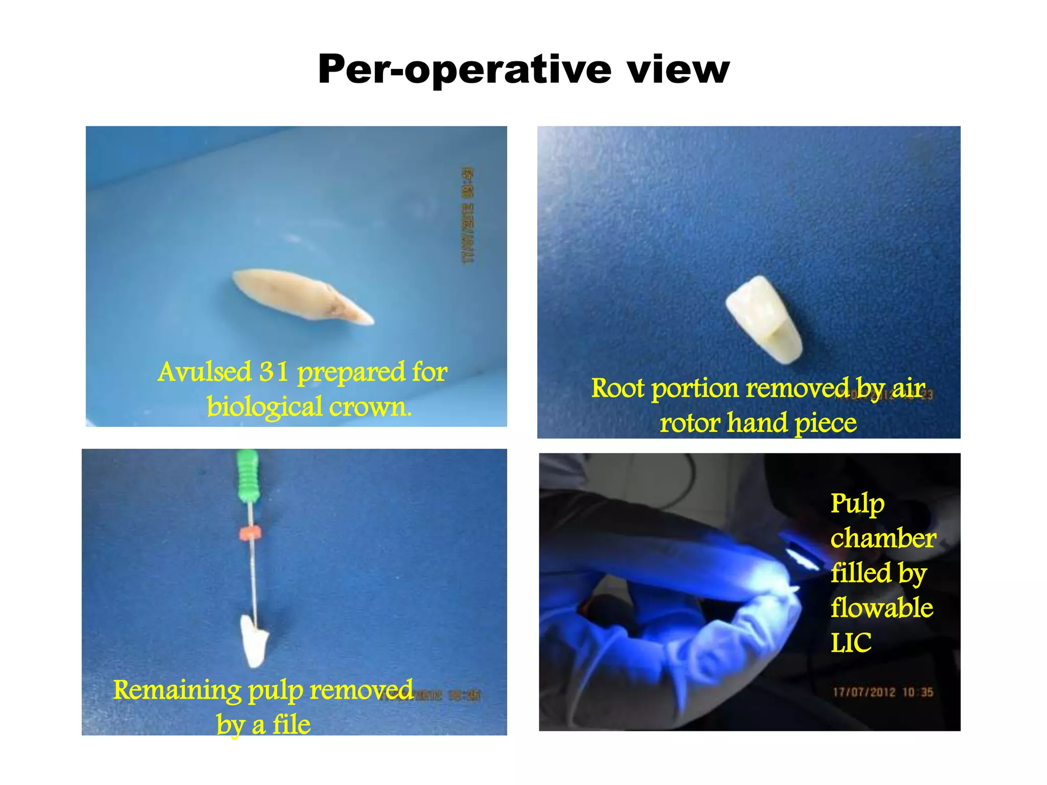 Biological crown | PPTX