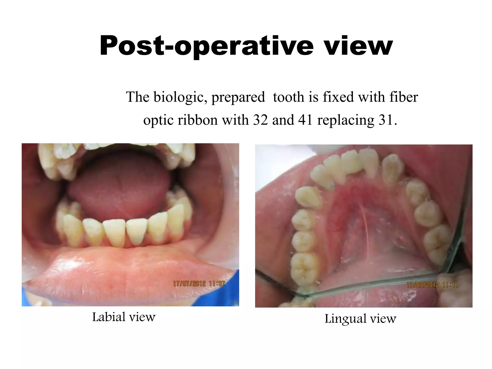 Biological crown | PPTX