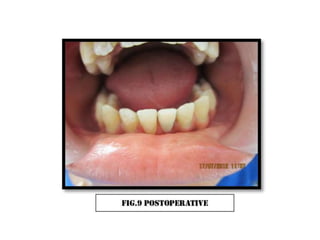 Biological crown | PPT