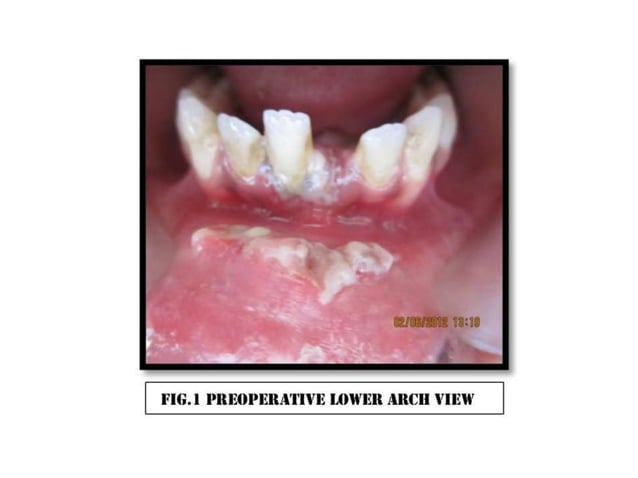 Biological crown | PPT