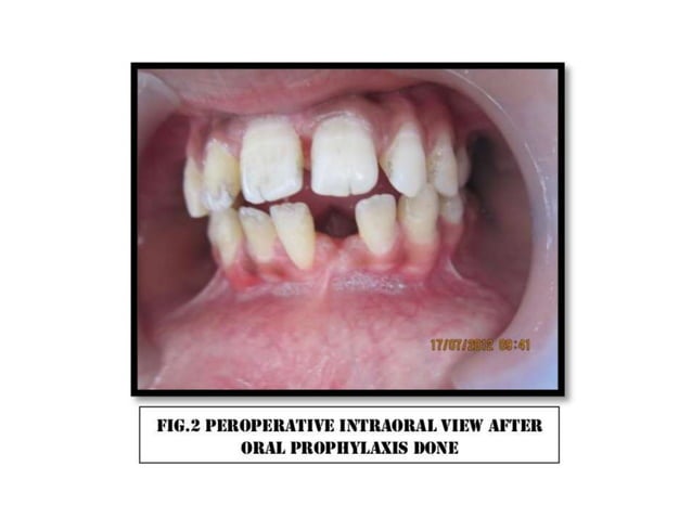 Biological crown | PPT