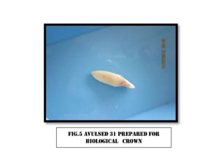 Biological crown | PPT