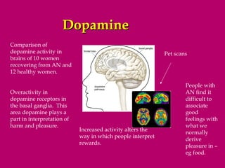 Biological: Neural explanations of anorexia A2 | PPT