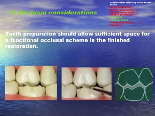 Biological principle of preparation ( crown ) | PPT