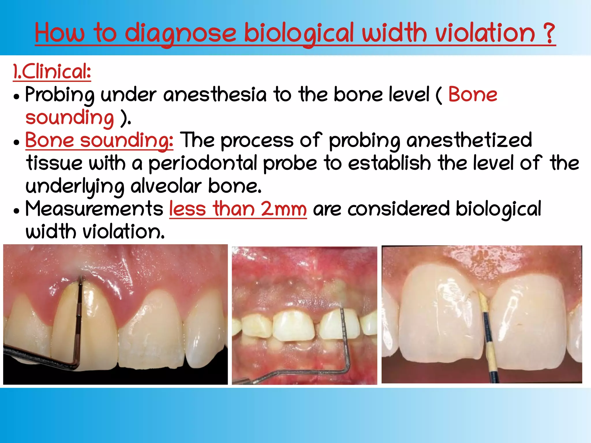 Biological width | PDF