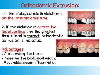 Biological width | PDF