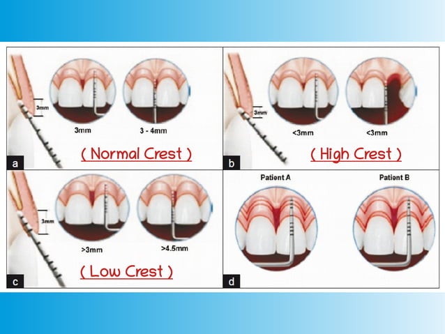 Biological Width Ppt
