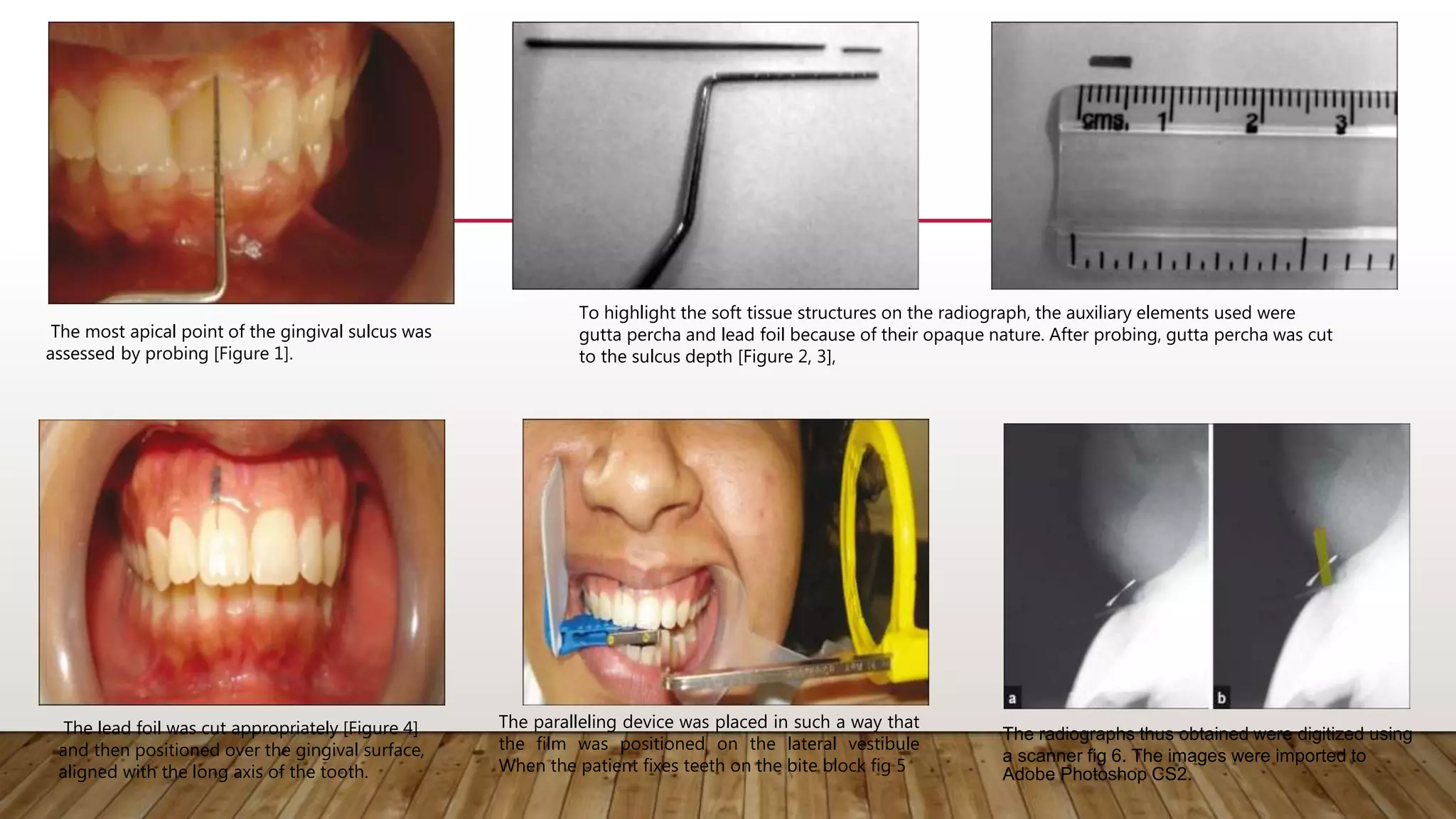 Biological width | PPTX