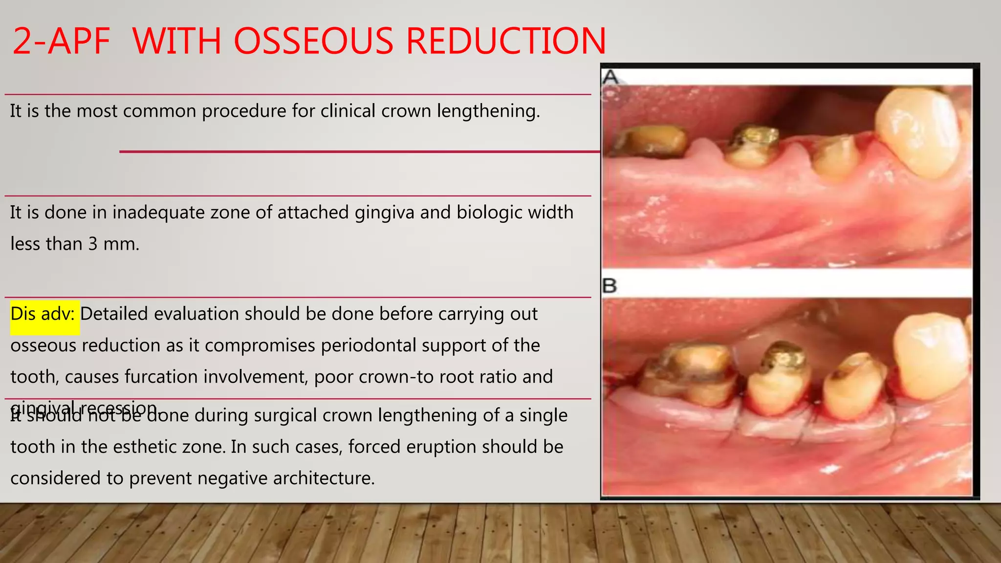 Biological width | PPTX