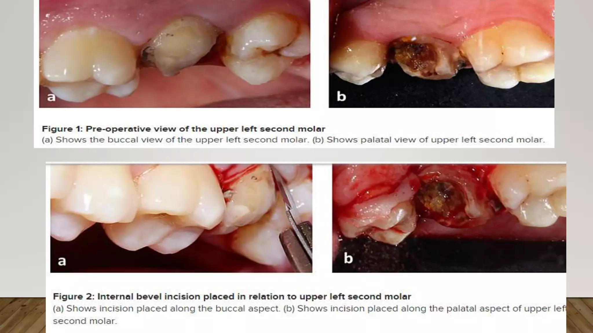 Biological width | PPTX
