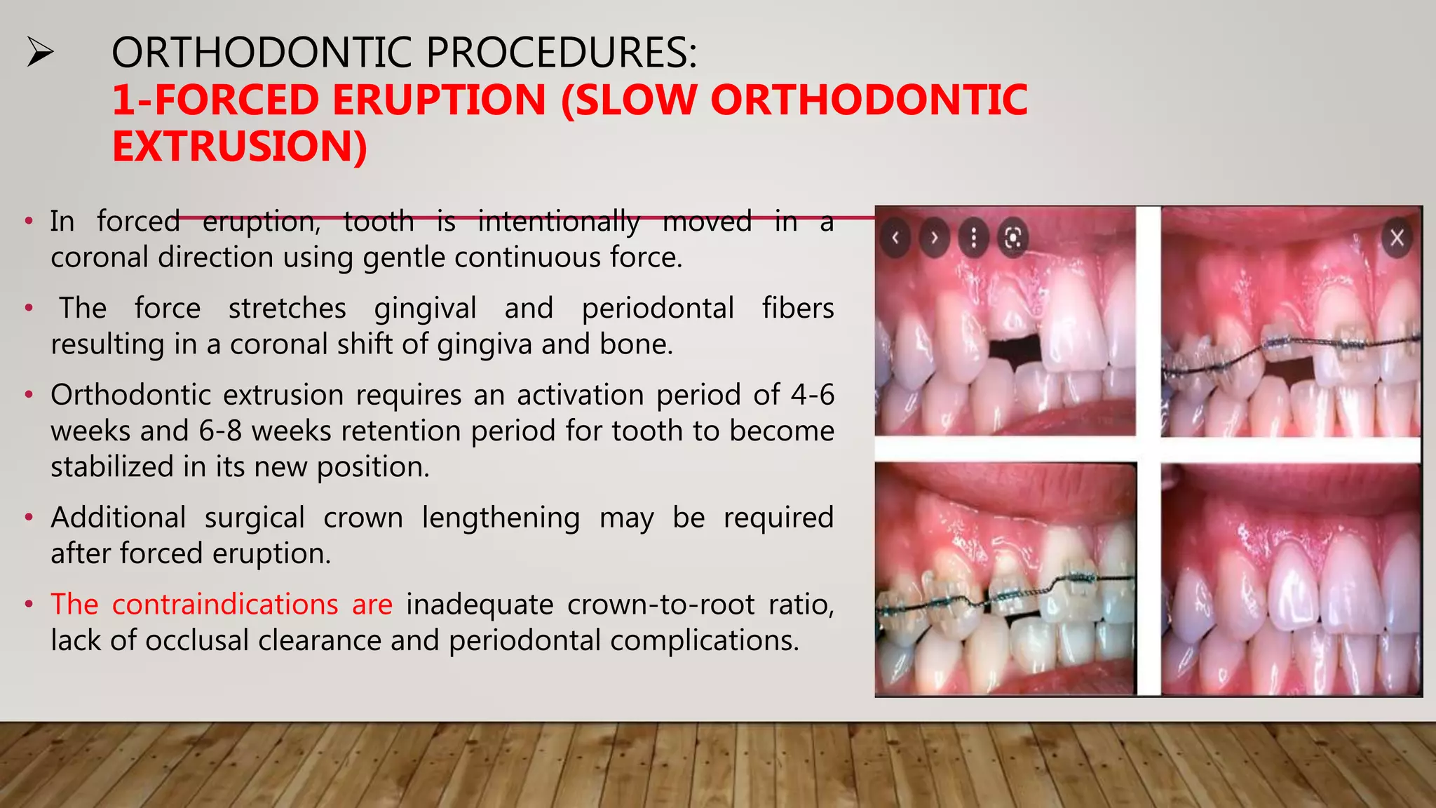 Biological width | PPTX