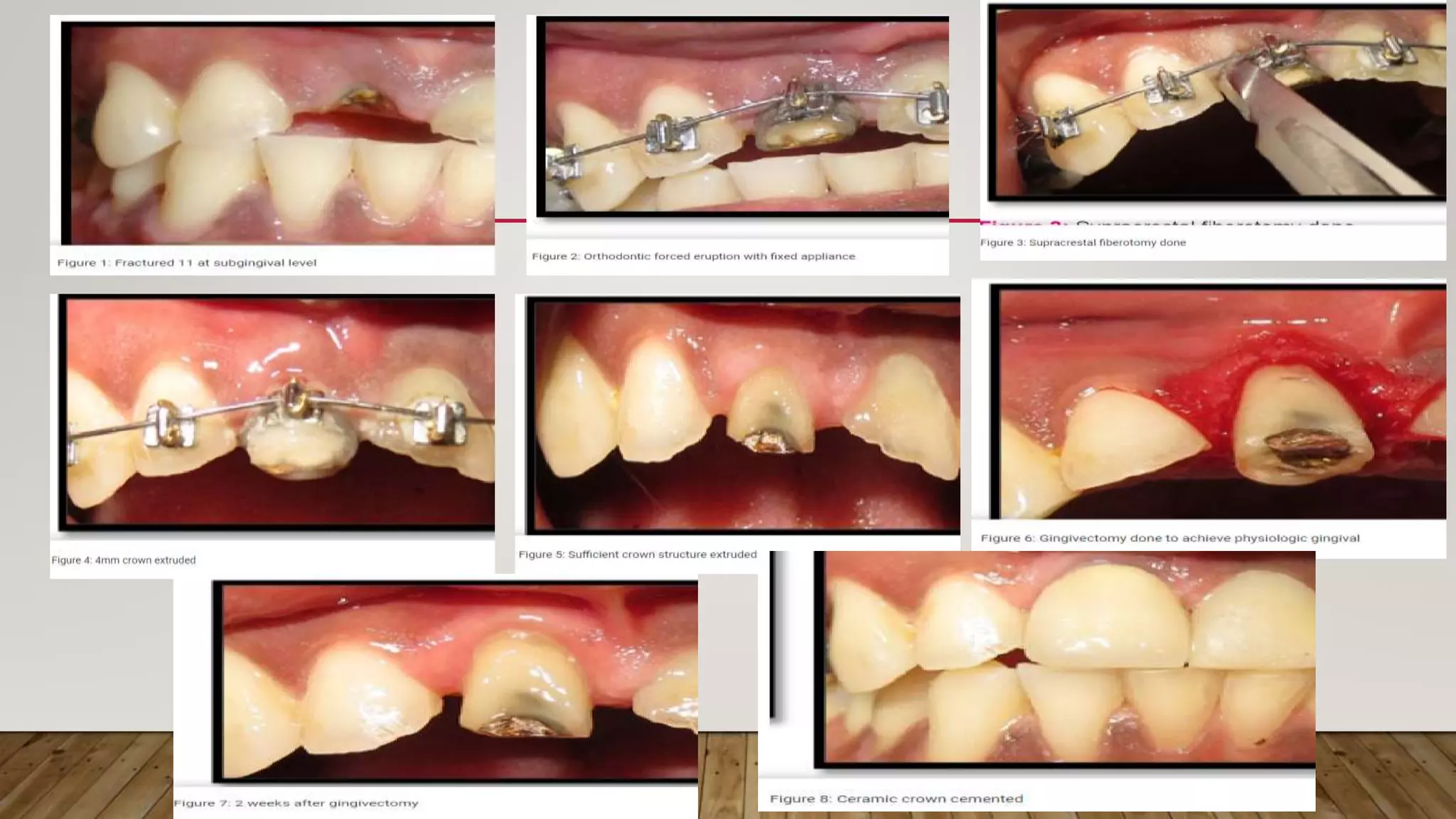 Biological width | PPTX