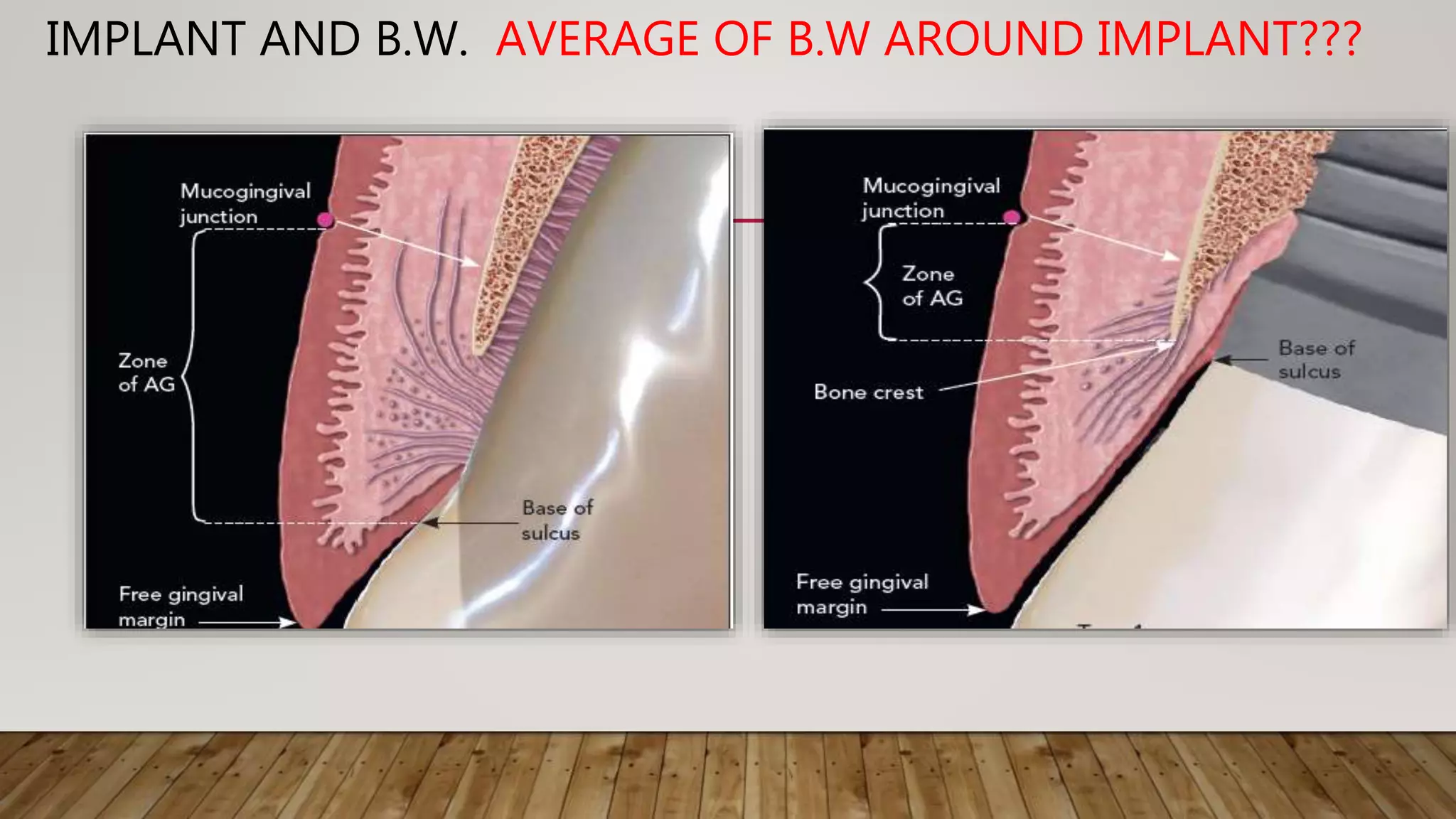 Biological width | PPTX | Dental Health | Diseases and Conditions