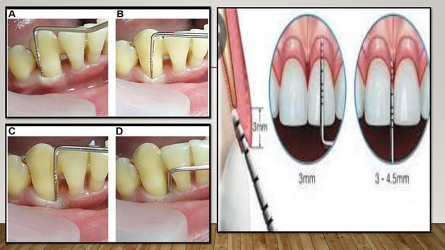 Biological width | PPTX | Dental Health | Diseases and Conditions