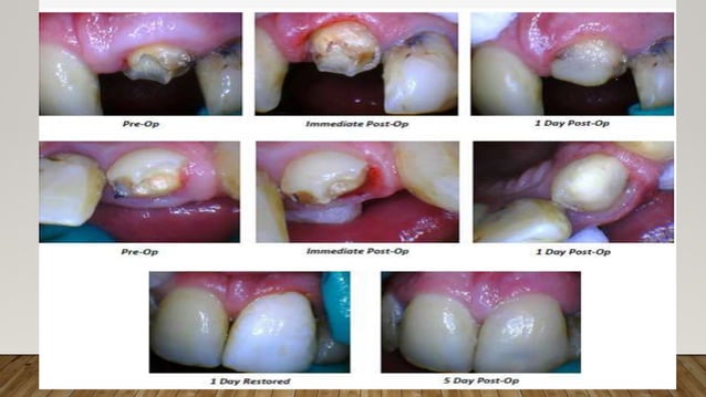 Biological width | PPTX | Dental Health | Diseases and Conditions