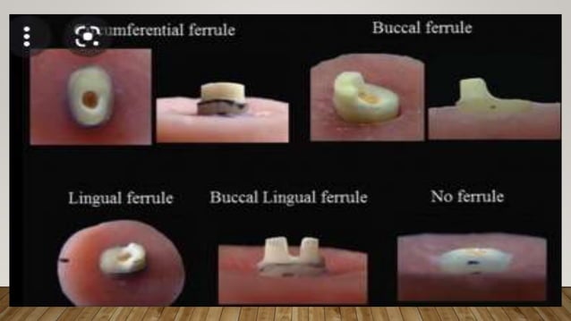 Biological width | PPTX | Dental Health | Diseases and Conditions