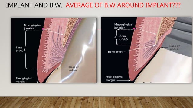 Biological width | PPTX | Dental Health | Diseases and Conditions