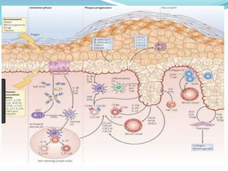 Biologics in psoriasis | PPTX