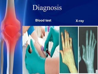 BIOLOGICS IN RHEUMATOID ARTHRITIS | PPT