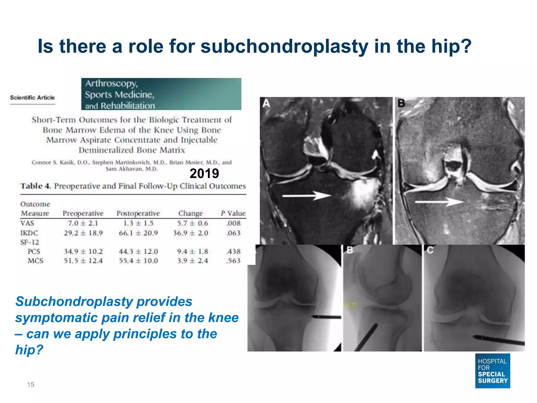 Bone Marrow Lesions of the Hip - Avascular Necrosis and Subchondral ...