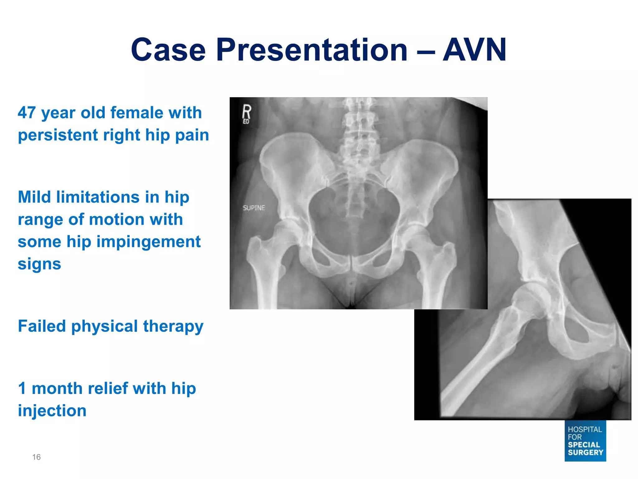 Bone Marrow Lesions of the Hip - Avascular Necrosis and Subchondral ...