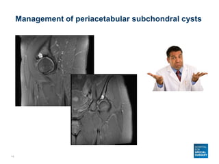 Bone Marrow Lesions of the Hip - Avascular Necrosis and Subchondral ...