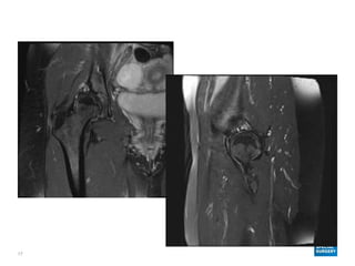 Bone Marrow Lesions of the Hip - Avascular Necrosis and Subchondral ...