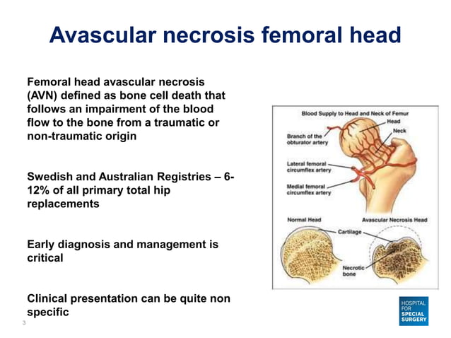 Bone Marrow Lesions of the Hip - Avascular Necrosis and Subchondral ...