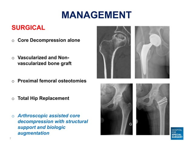 Bone Marrow Lesions of the Hip - Avascular Necrosis and Subchondral ...
