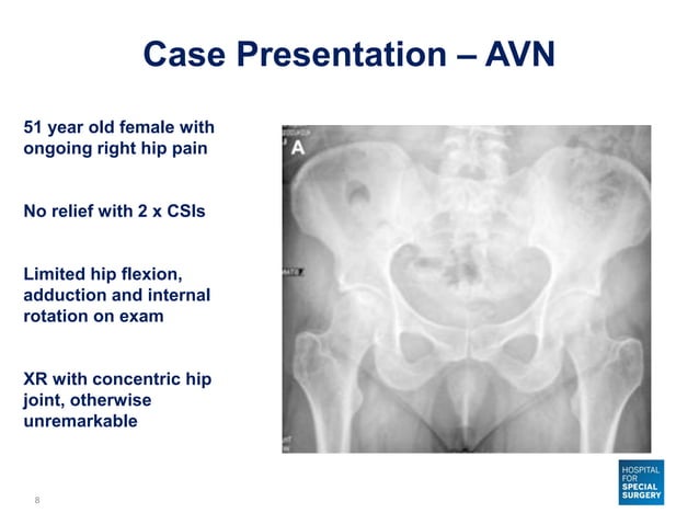 Bone Marrow Lesions of the Hip - Avascular Necrosis and Subchondral ...