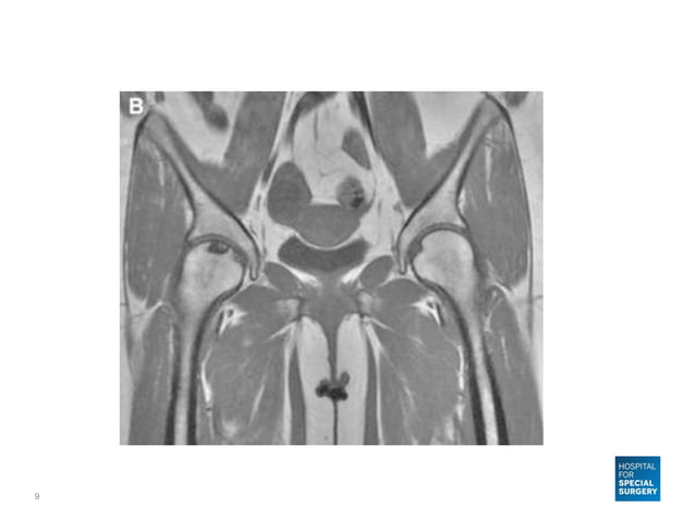 Bone Marrow Lesions of the Hip - Avascular Necrosis and Subchondral ...